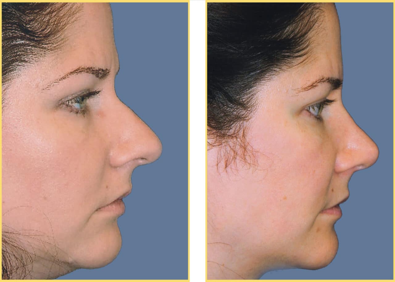 Rhinoplasty (Nose Job)